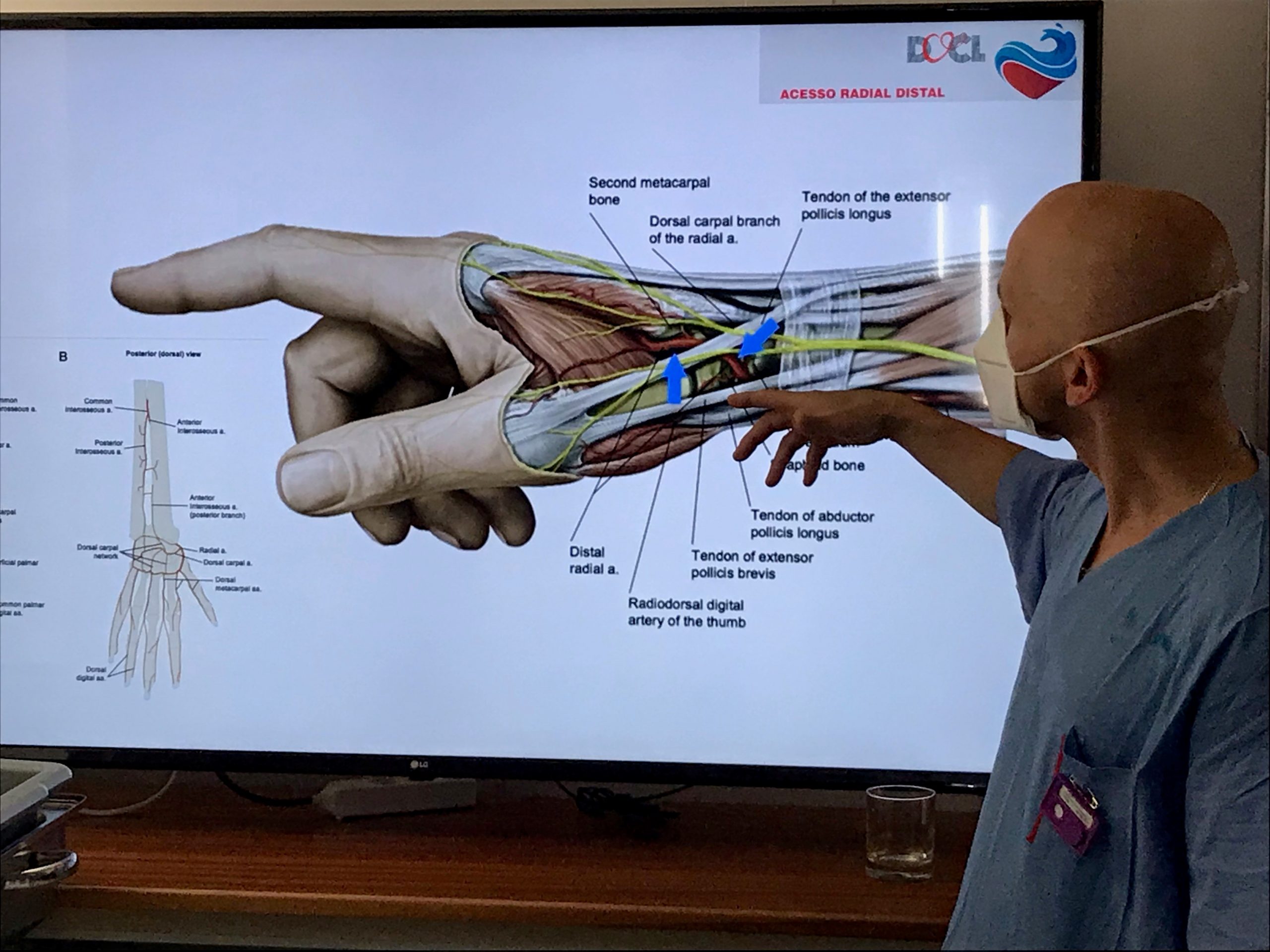 Cardiologistas de intervenção divulgaram acesso radial distal em Faro